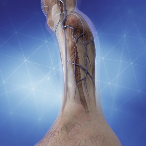 ArtStation - Varicose Veins, medical animation