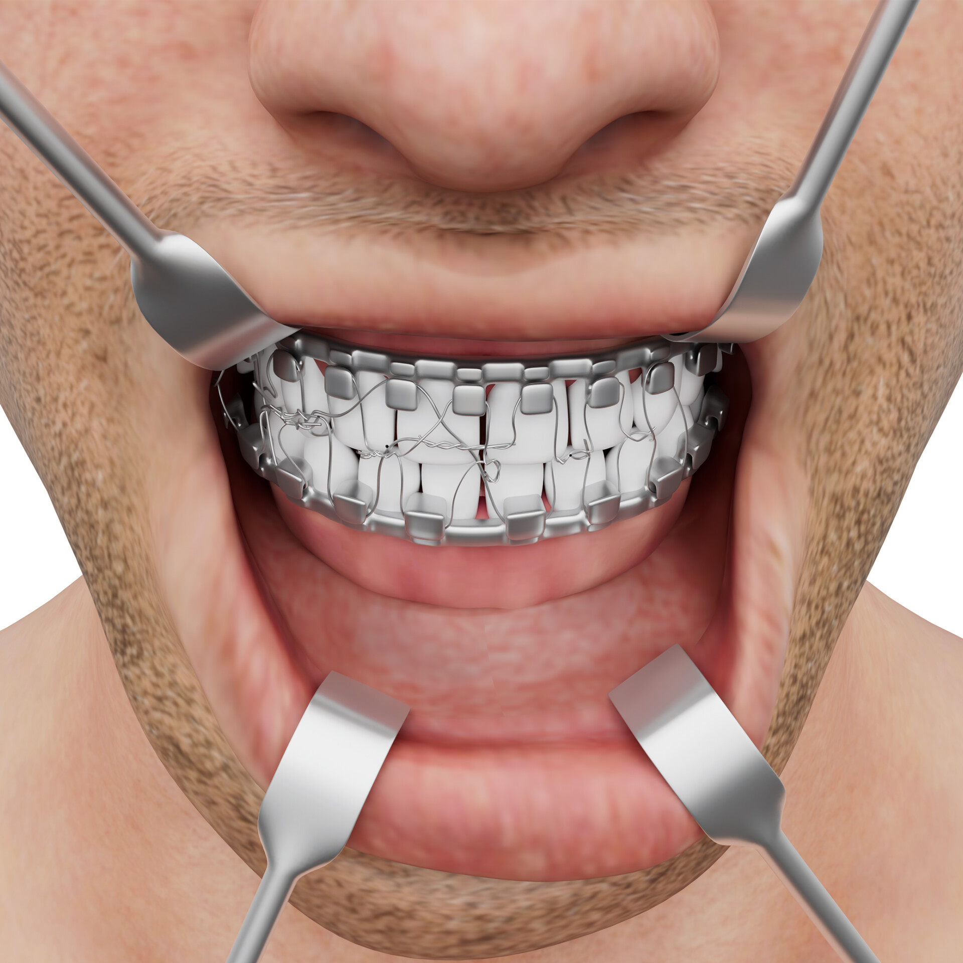 ArtStation - 3D Medical Animation | Mandibular fracture