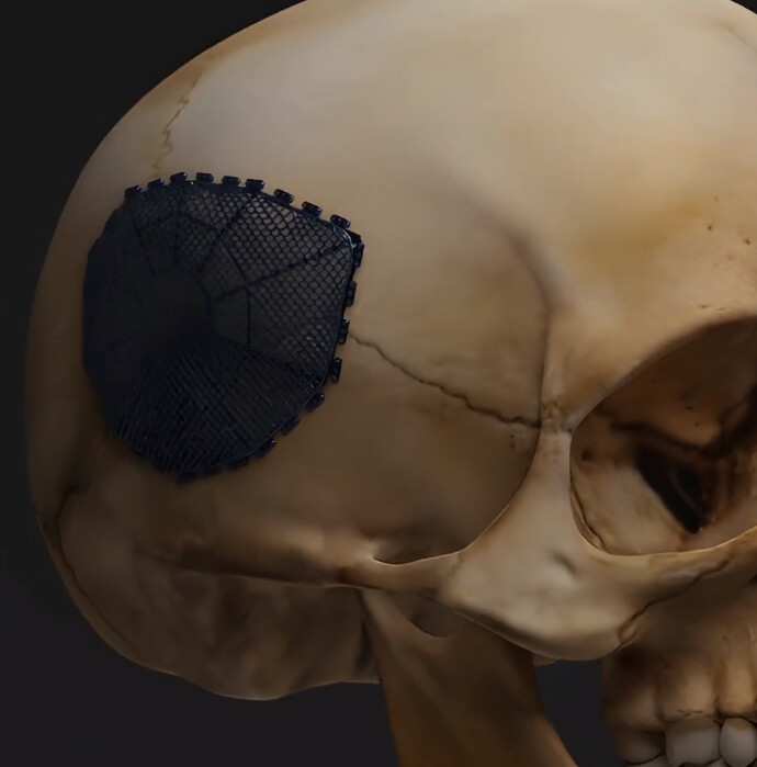 ArtStation - Neurosurgical Cranial Plate Implant