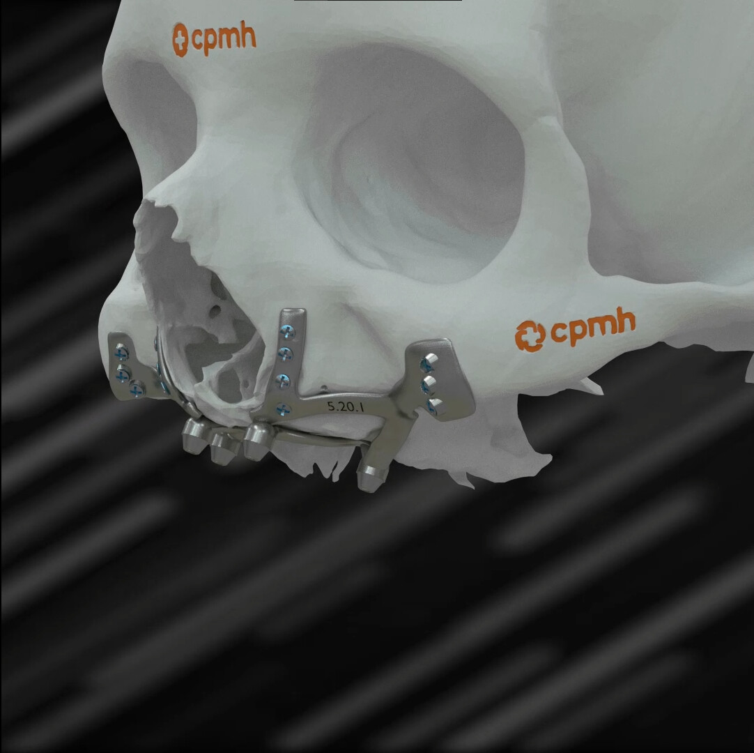 ArtStation - Full Maxillary Reconstruction Animation