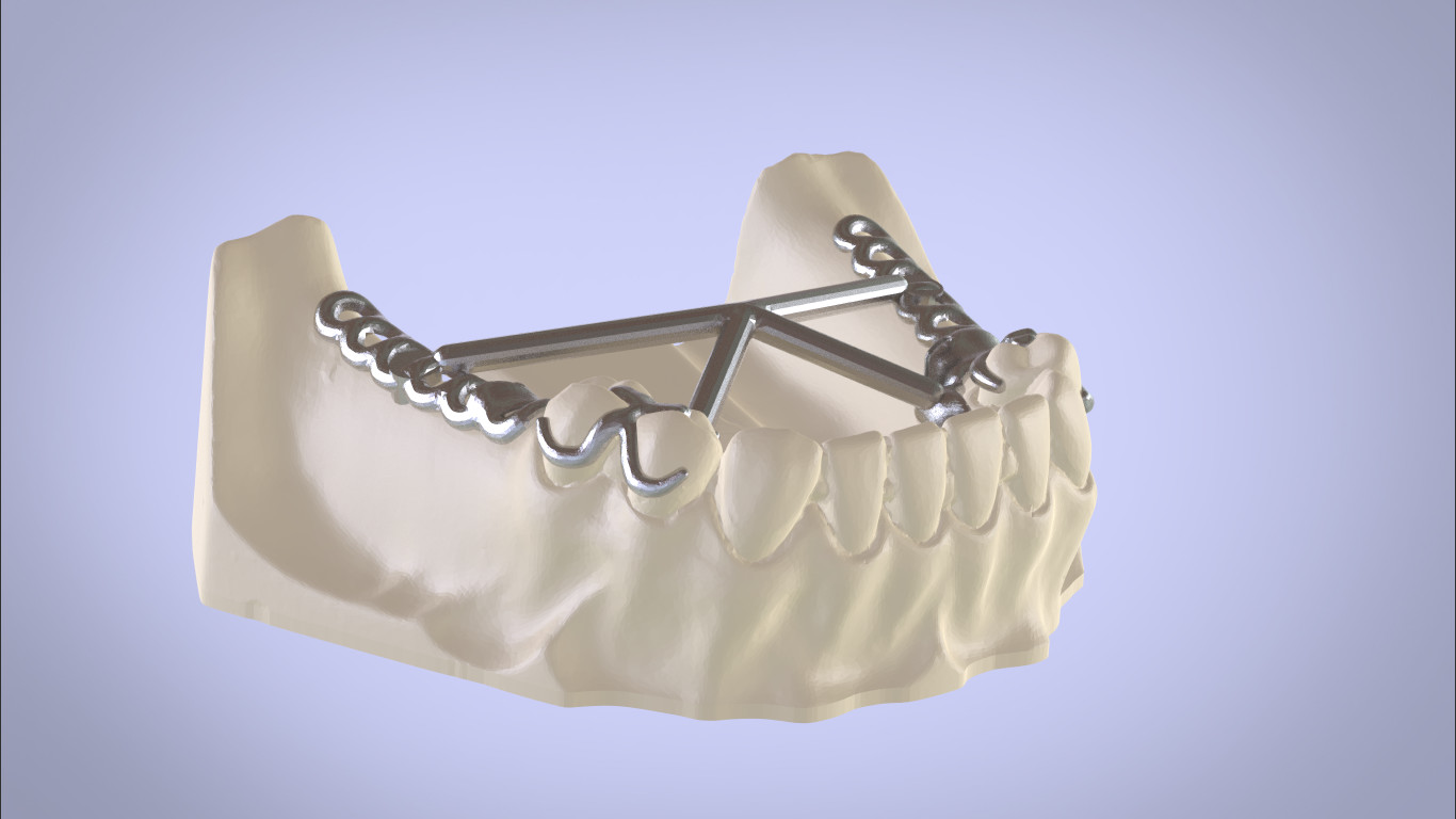 LabMagic 3D DentCAD - Digital 3D Removable Partial Denture