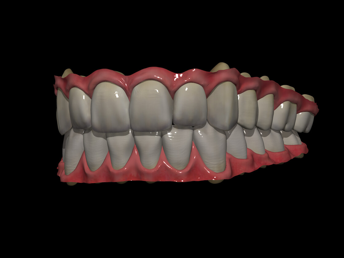 Renzo Zanin - Denture Teeth - Ivory Digital Denture Software