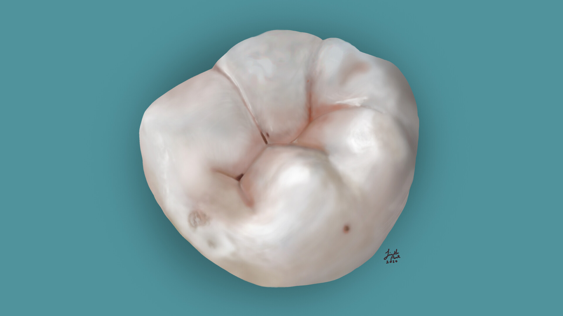 Stephano P - Molar Cavities