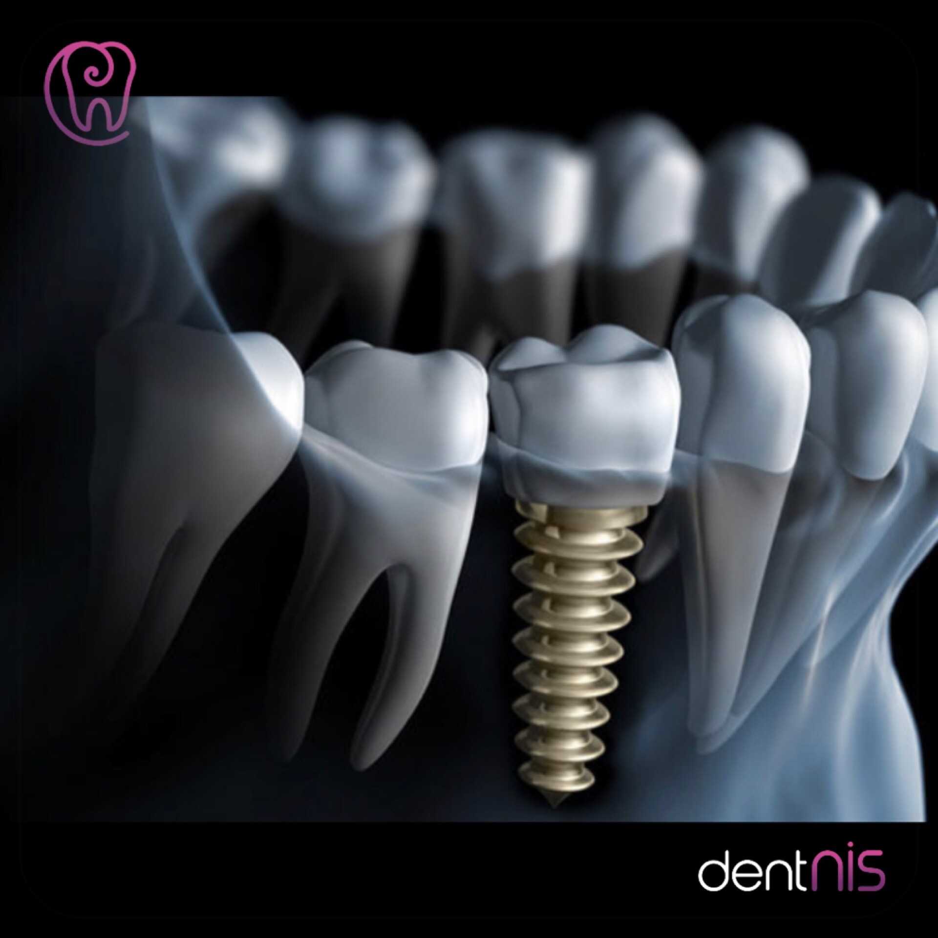 ArtStation - implant