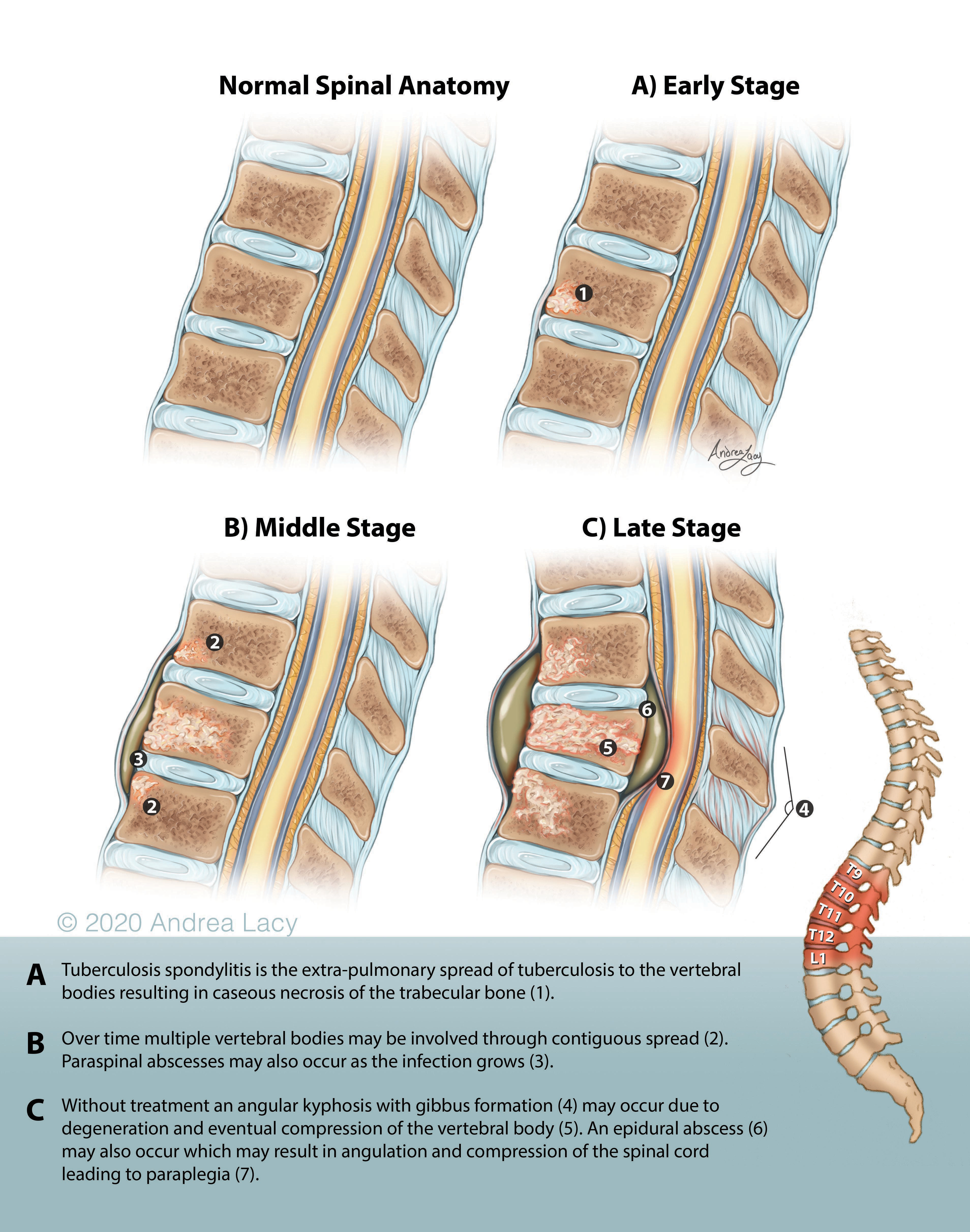 Andrea Lacy biomedical illustration - Tuberculosis Spondylitis