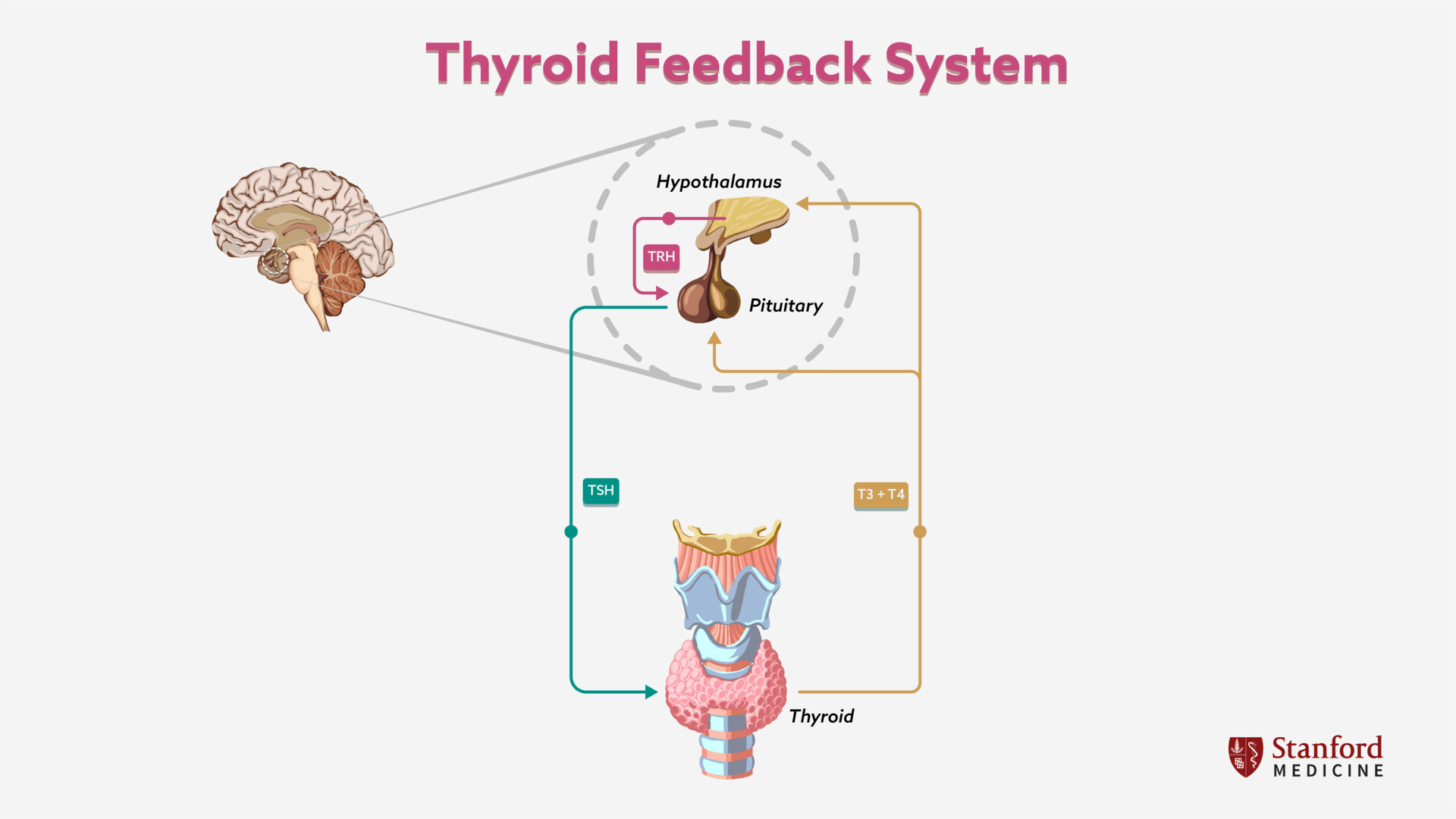 Huy Tran - Congenital Hypothyroidism