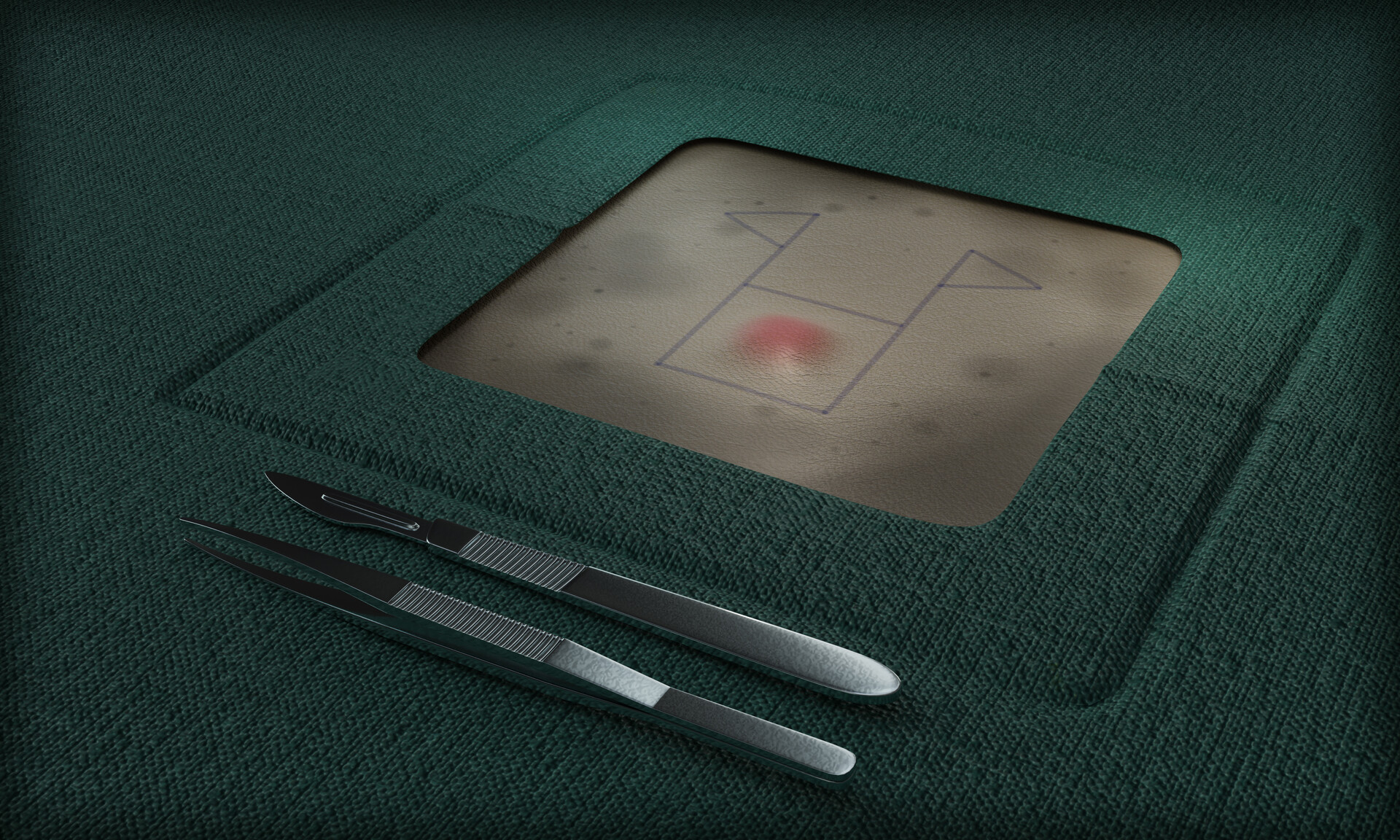 ArtStation - Burow´s triangle surgery