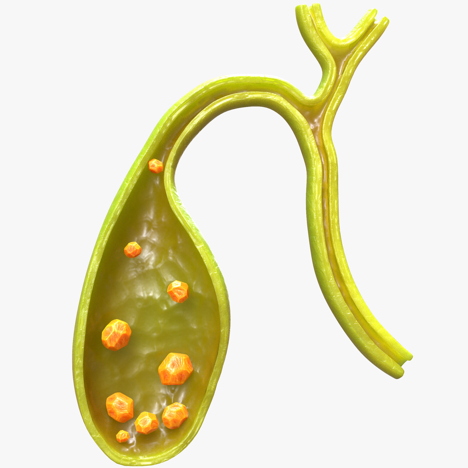 ArtStation - Gallbladder with Gallstones