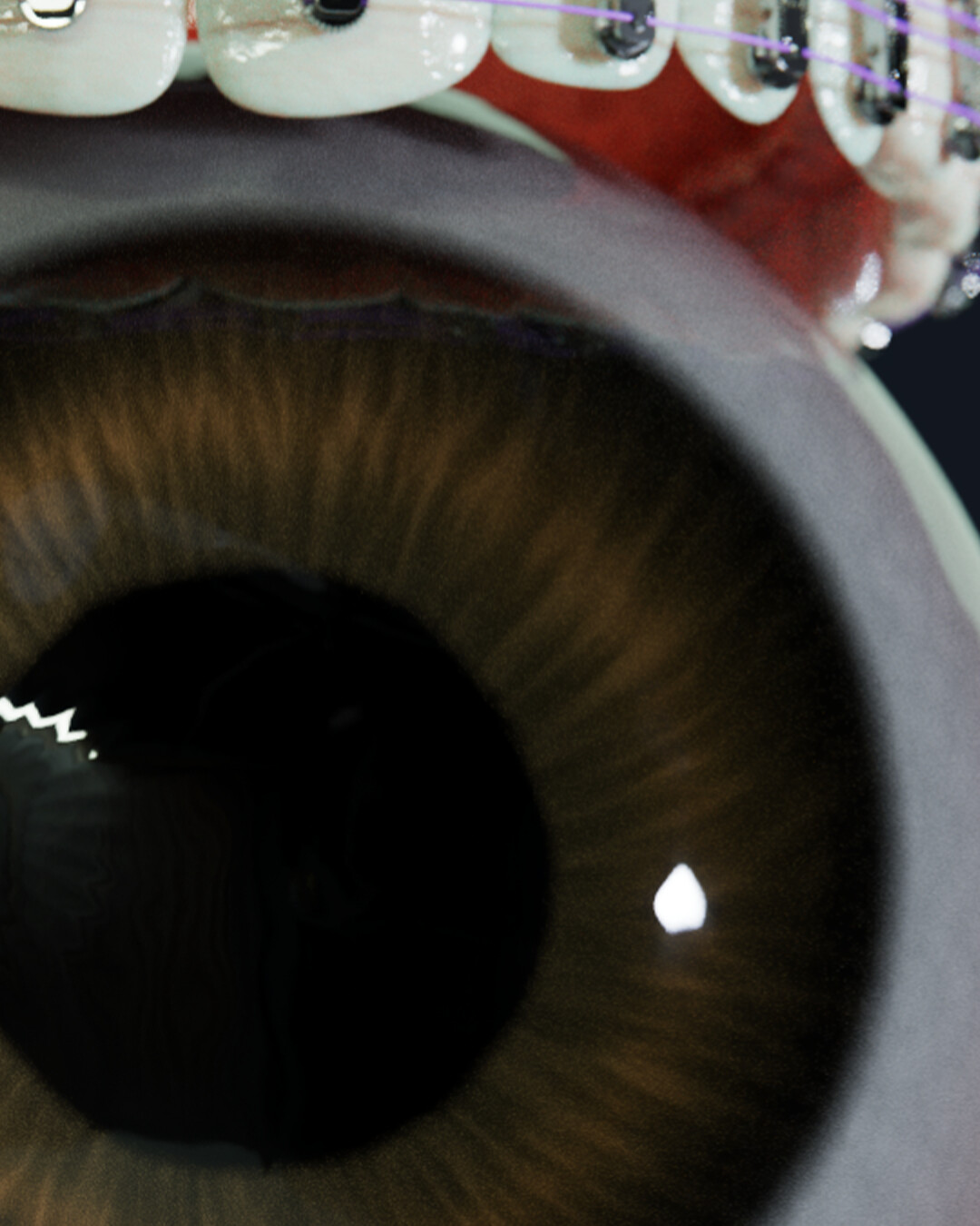 Randy Bruner - Braces