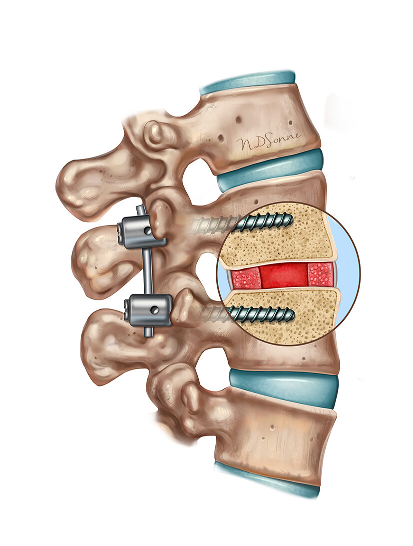 ArtStation - Medical illustration of a spine and MIS TLIF surgery