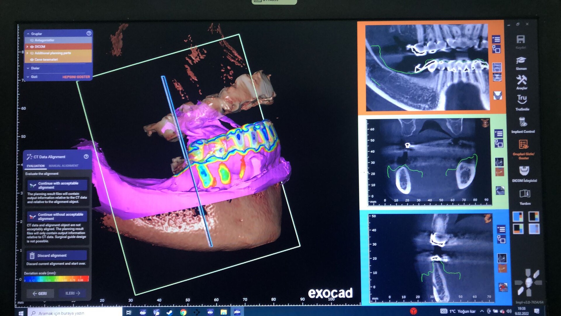 ArtStation - Exoplan, Dental Implant Surgical Guide