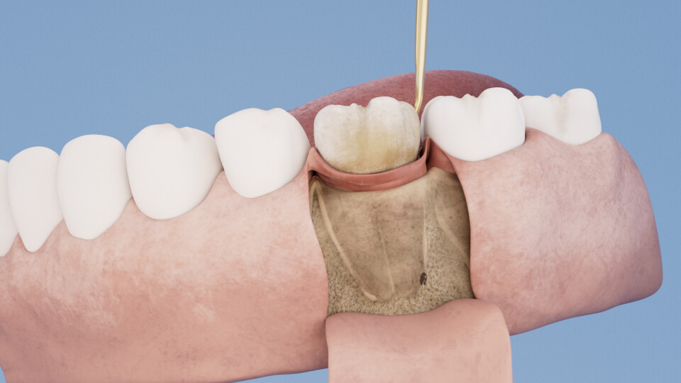tooth removal animation