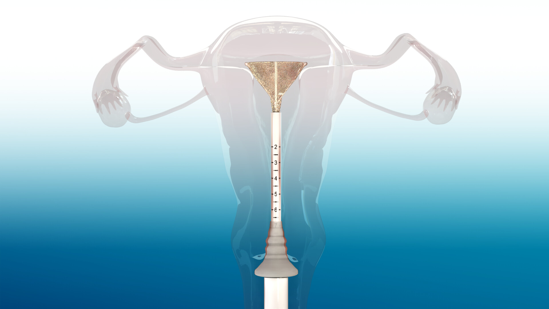 Ashley Mellor - NovaSure V5 Device