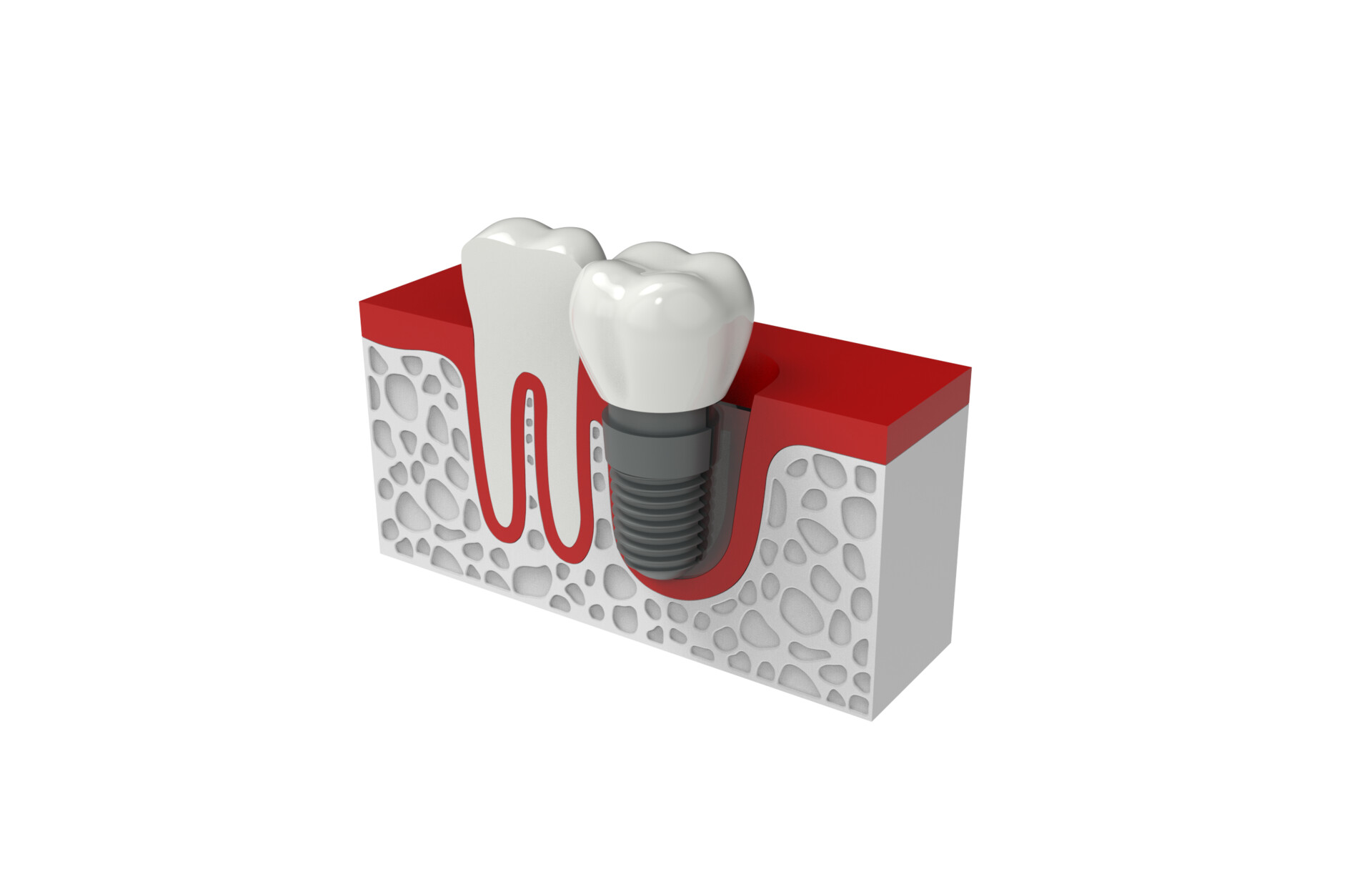 ArtStation - Implant model