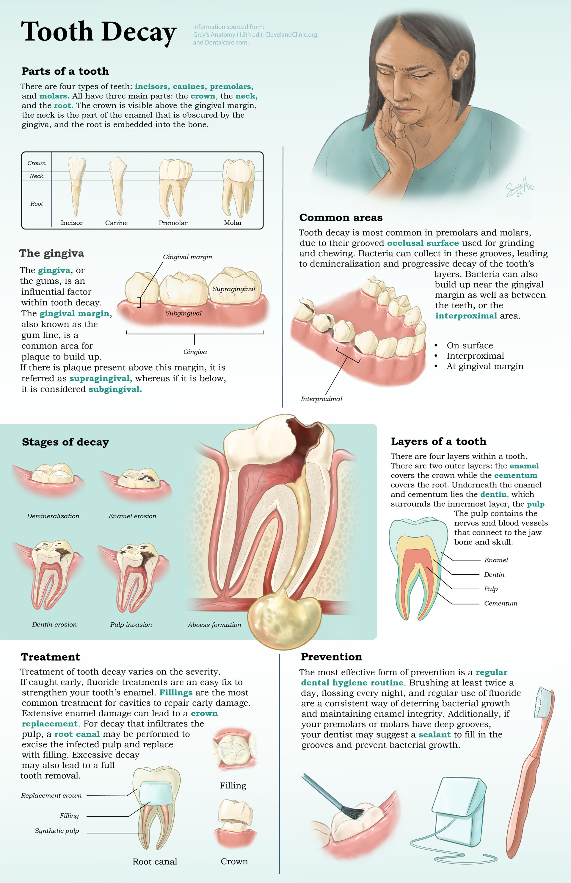 Susie Hammons - Tooth Decay