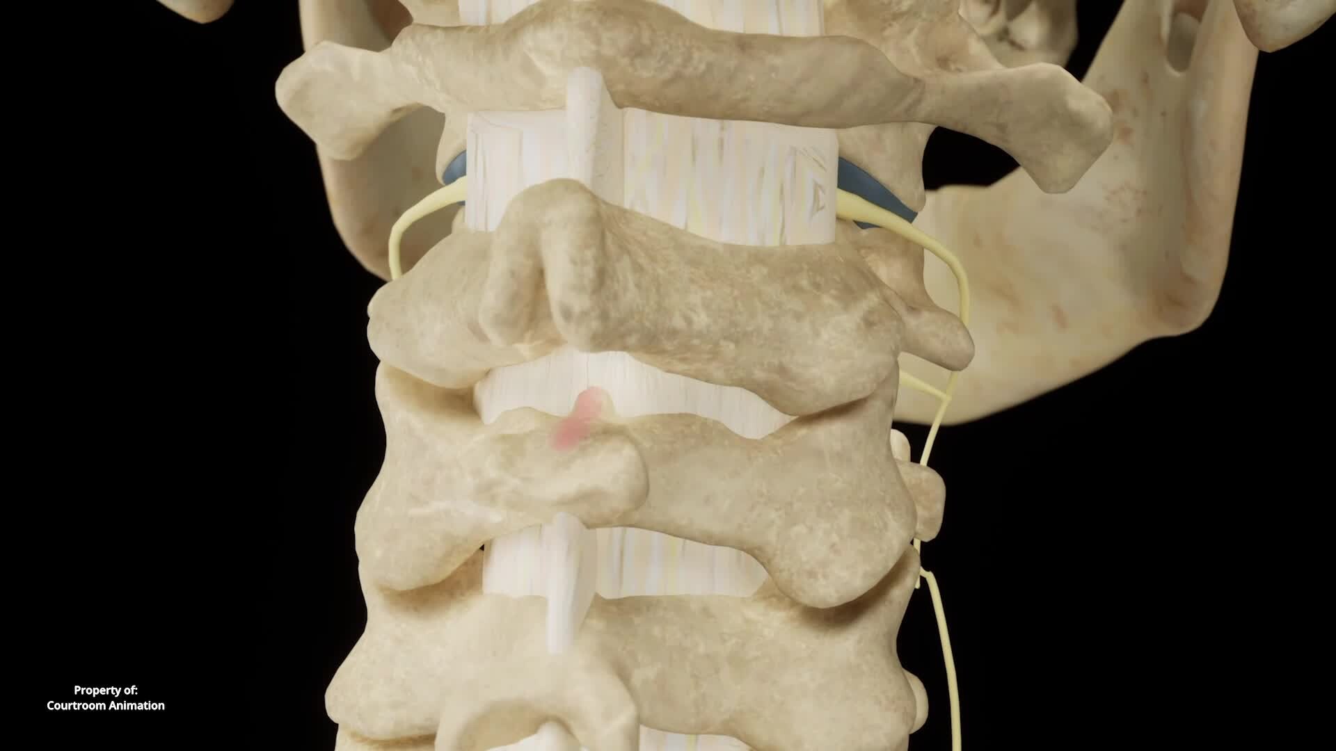 ArtStation - Discectomy, Cervical - CA