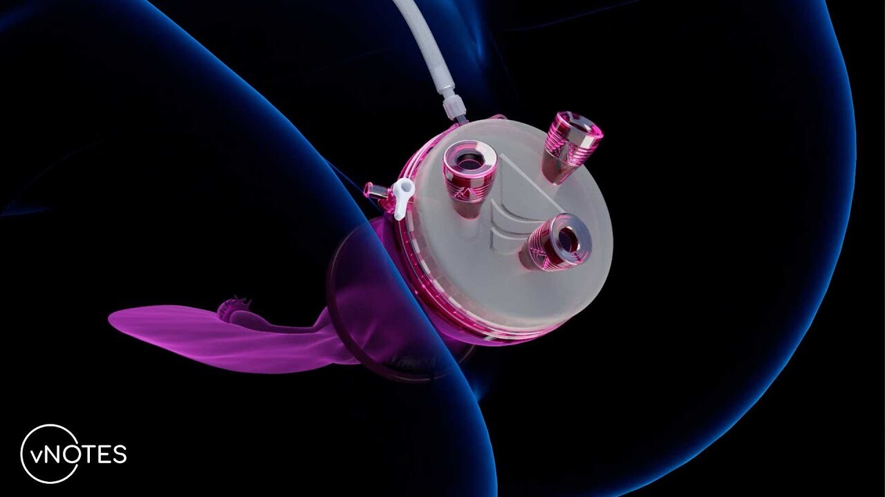 ArtStation - vNOTES Hysterectomy featuring the GelPOINT® V-Path ...