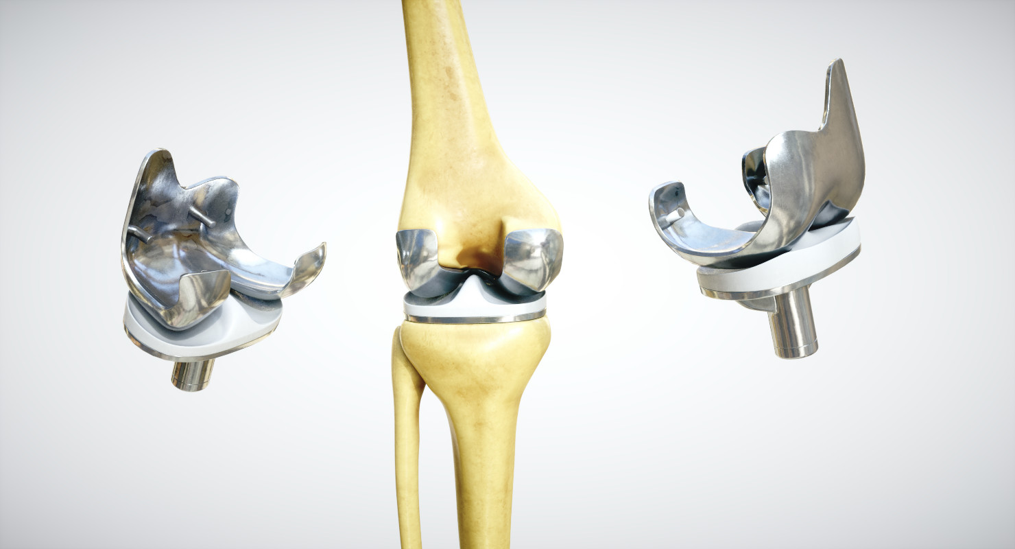 ArtStation - Knee endoprosthesis | Resources