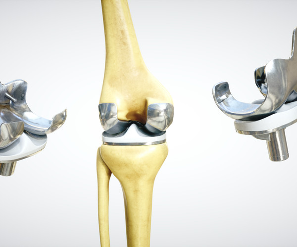 ArtStation - Knee endoprosthesis | Resources