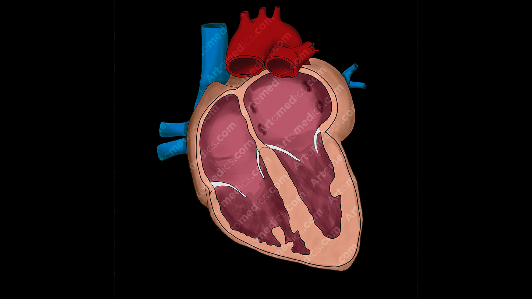 Heidi H. MD | Artomedics Studio - Left Atrial Enlargement (Anterior View)