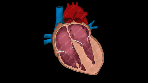 ArtStation - Left Ventricular Hypertrophy (Anterior View) | Artworks