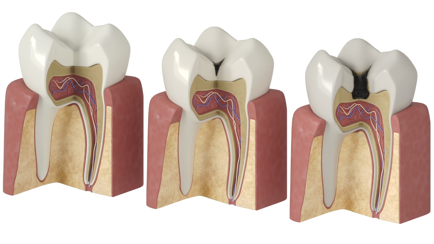ArtStation - Tooth decay stages cavity caries | Resources