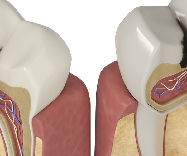 ArtStation - Tooth decay stages cavity caries | Resources